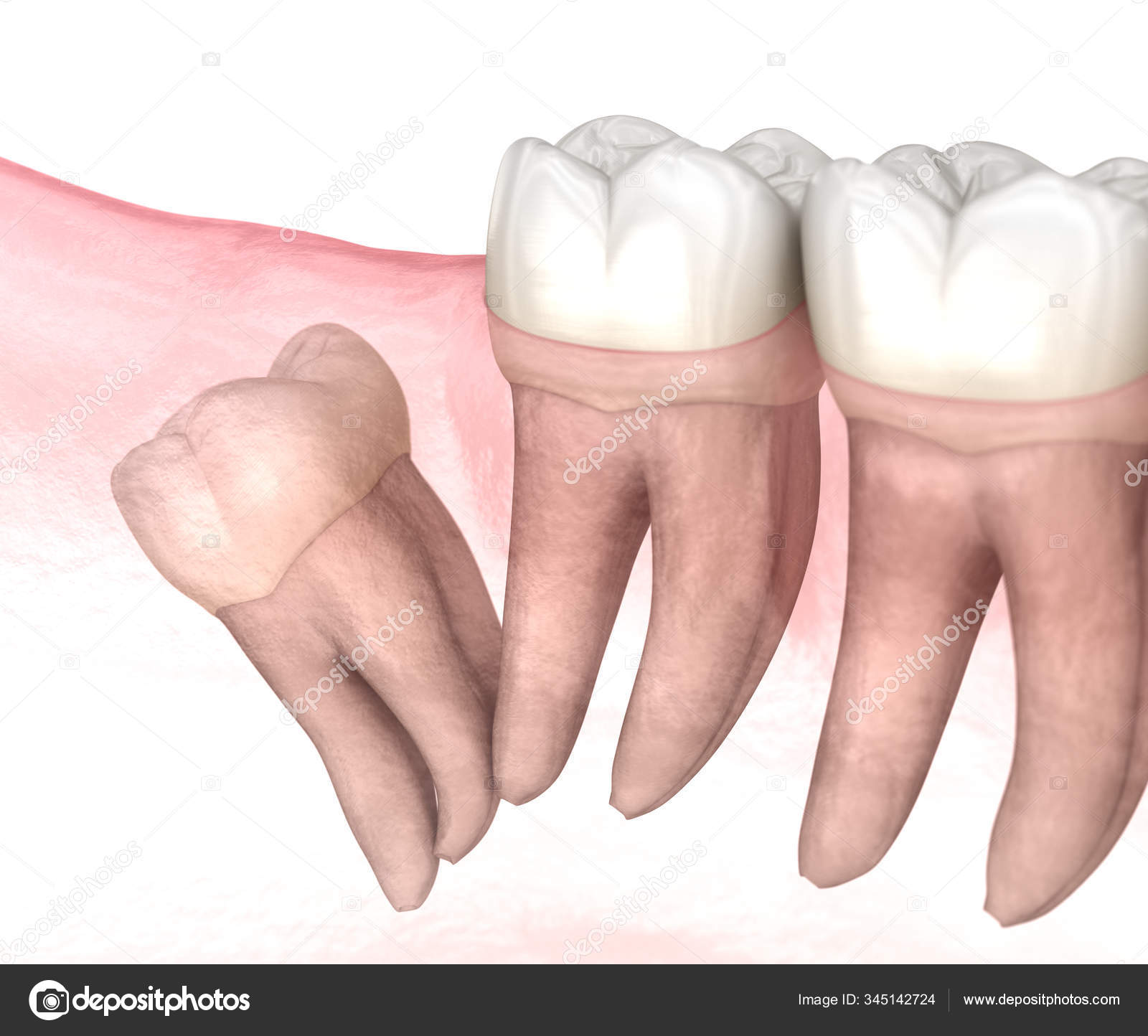 Impacto Distal Muela Sabiduría Ilustración Dientes Médicamente Precisos ...