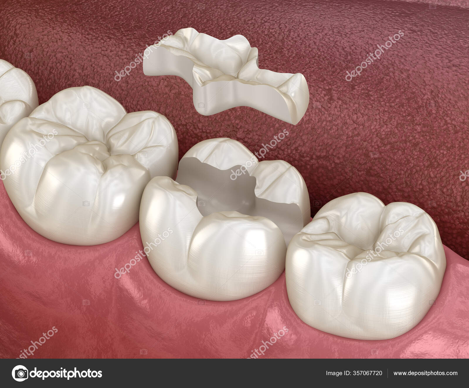 Inlay Ceramic Crown Fixation Tooth Medically Accurate Illustration ...