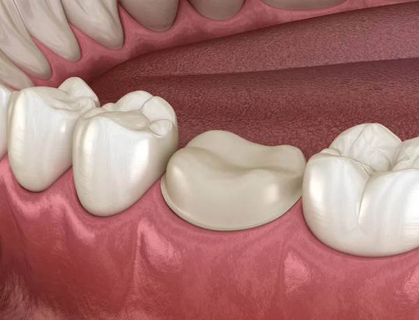 Preparated molar tooth for dental crown placement. Medically accurate ...