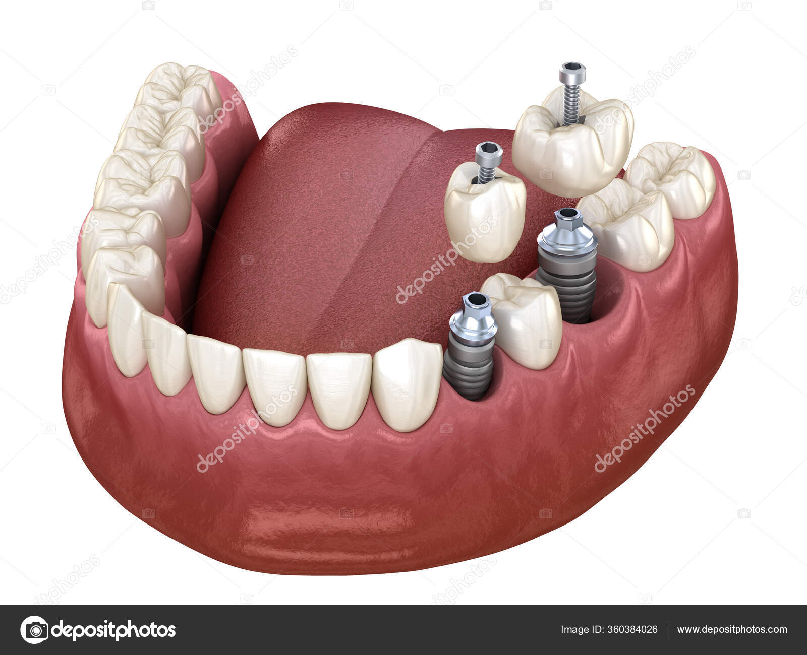 Premolar Molar Tooth Crown Installation Implant Screw Fixation ...