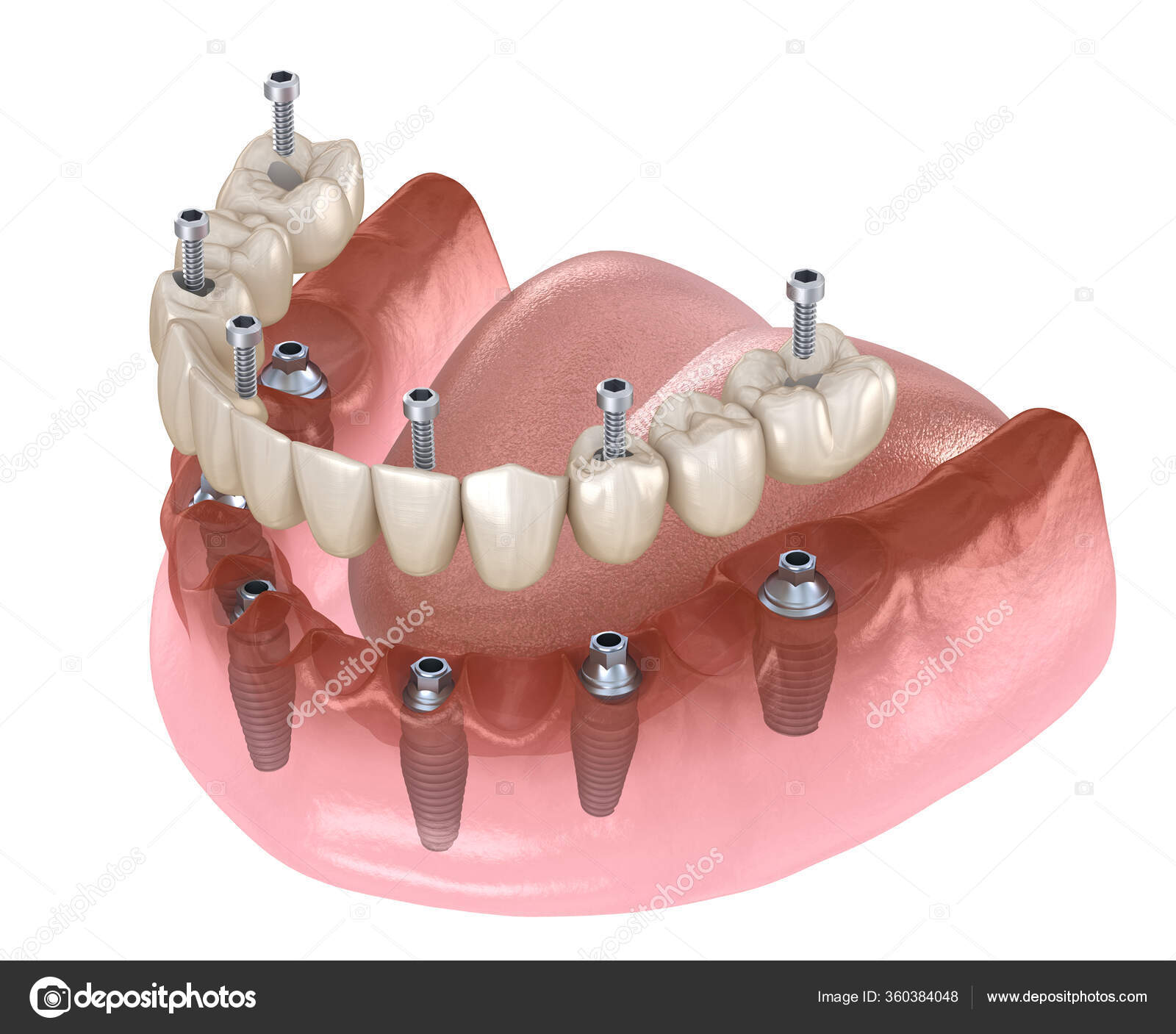Mandibular Prosthesis All System Supported Implants Screw Fixation ...