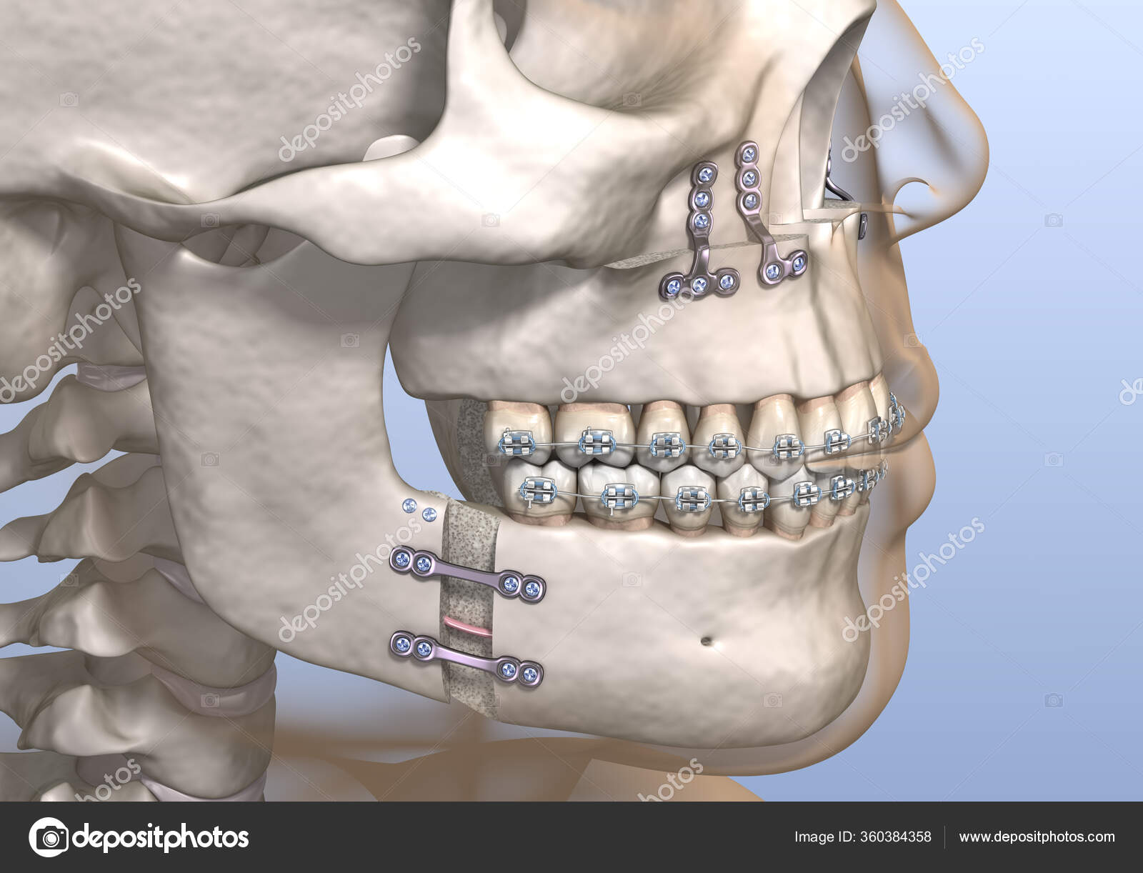 Maxillomandibular Advancement Surgery Ilustración Dental Médicamente ...