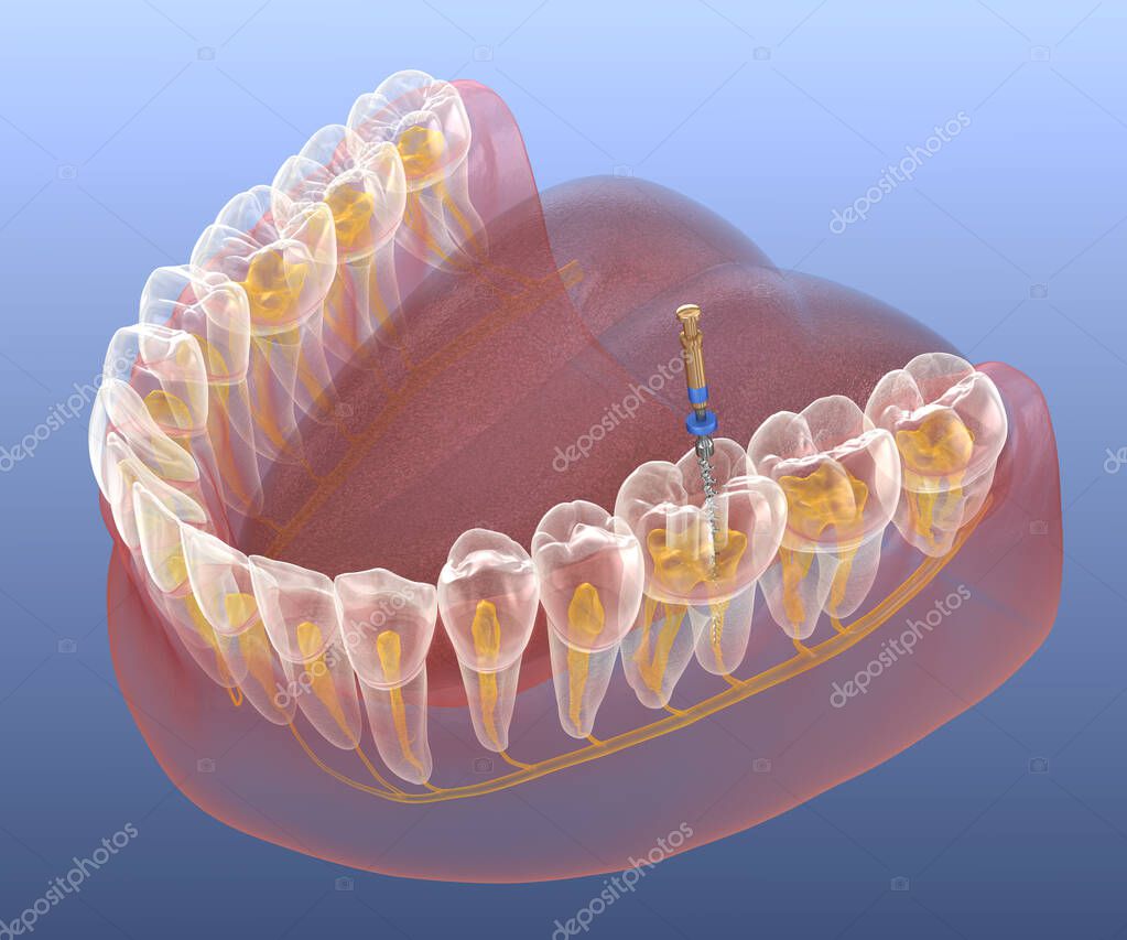 Tratamiento endodóntico del conducto radicular. Ilustración 3D de ...