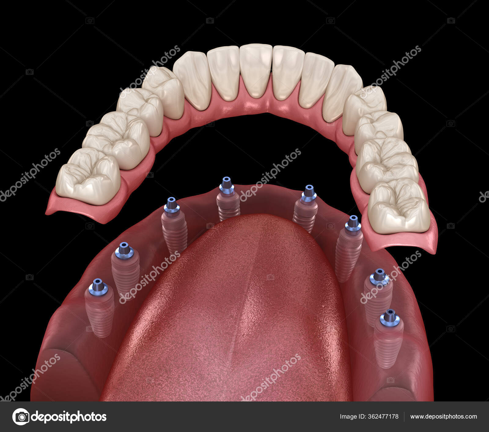 Mandibular Prosthesis All System Supported Implants Medically Accurate ...