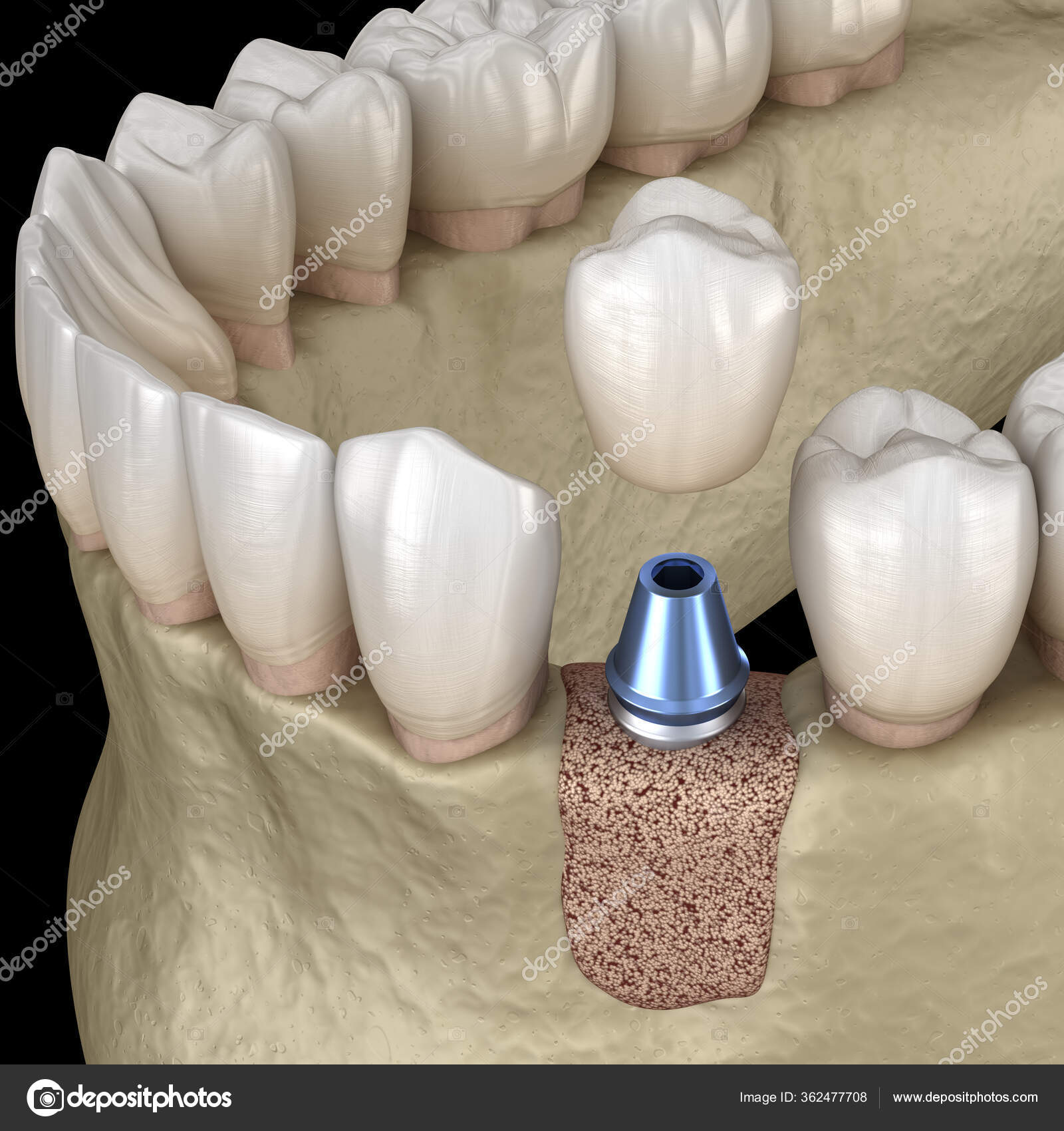 Augmentation Surgery Adding New Bone Illustration — Stock Photo ...