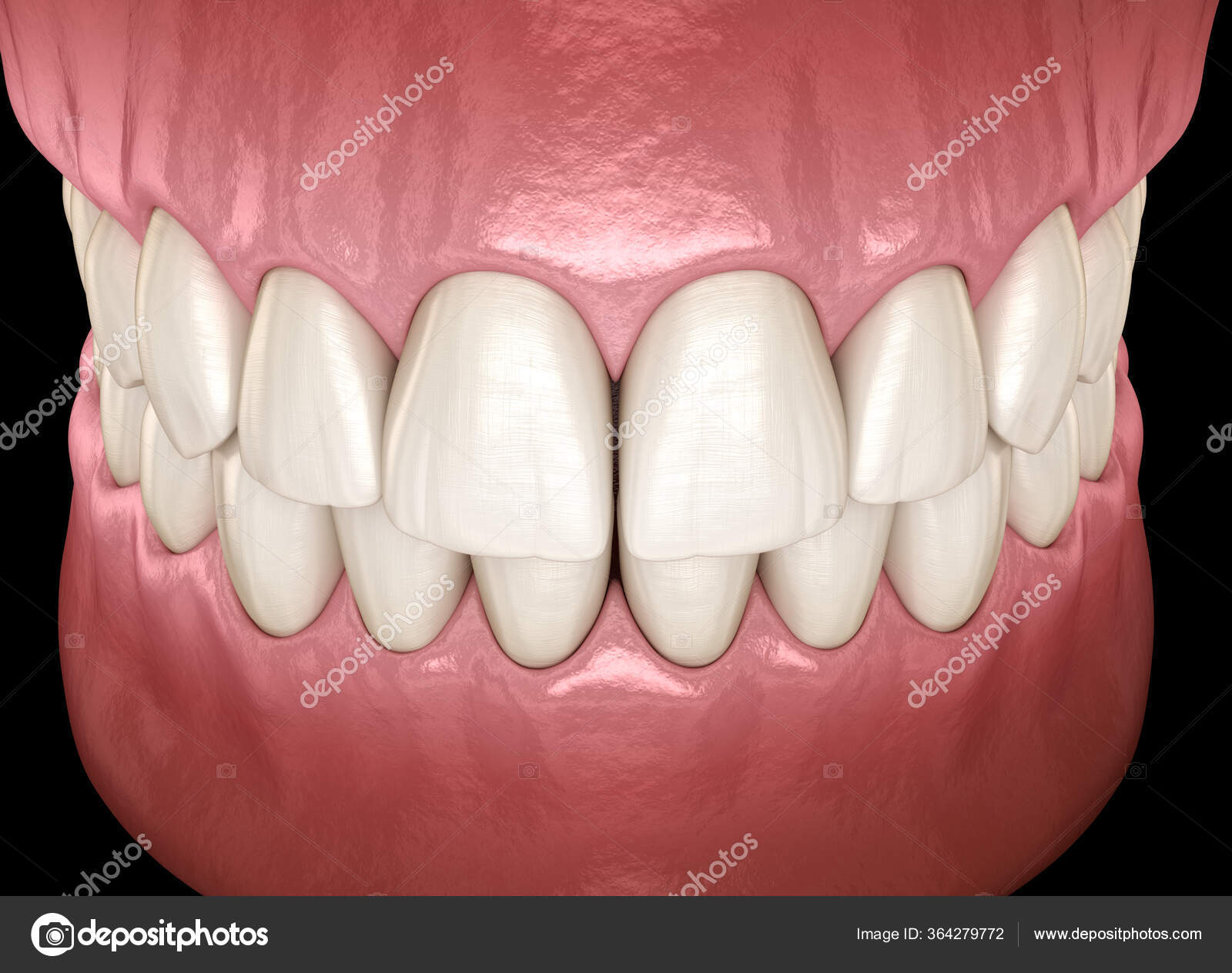 Dientes Humanos Sanos Con Oclusión Normal Vista Lateral Ilustración ...