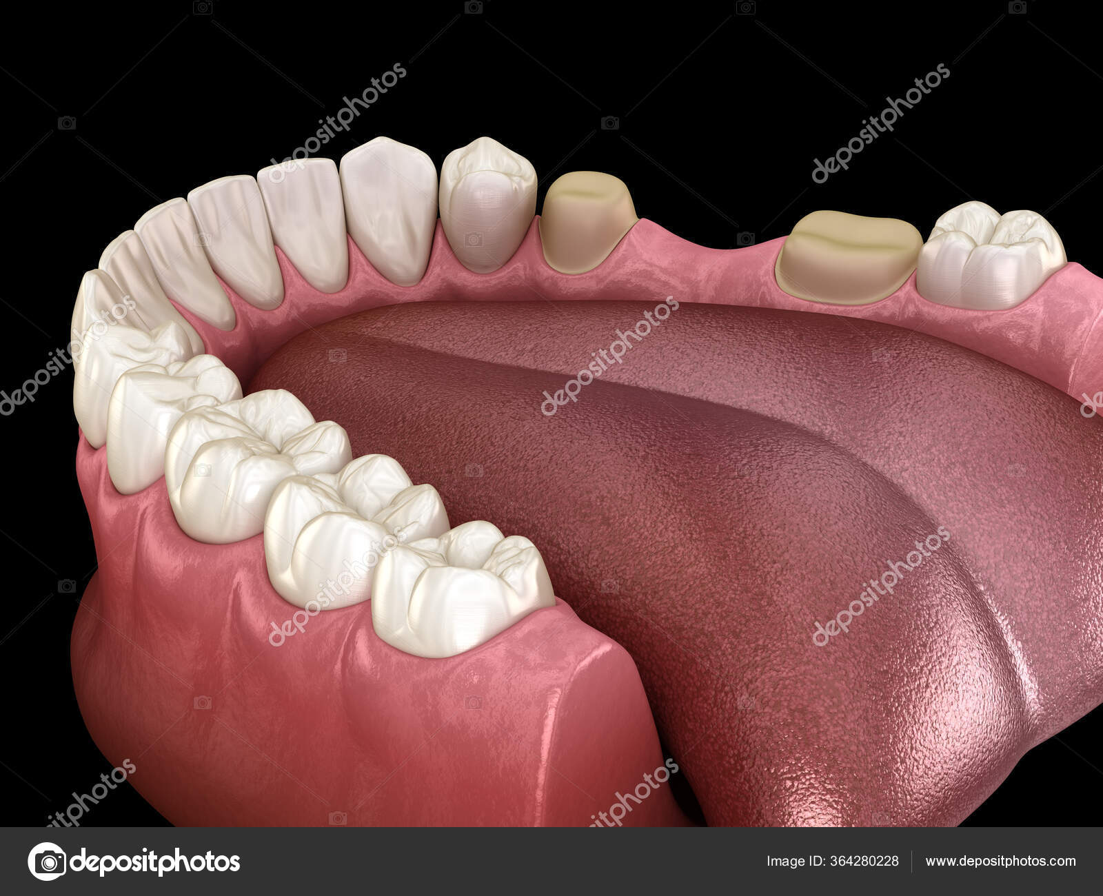 Preparated Molar Premolar Tooth Dental Bridge Placement Medically ...