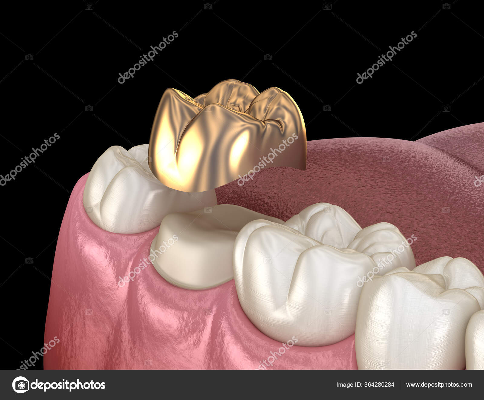 Couronne Dorée Molaire Processus D'assemblage Dents Illustration ...