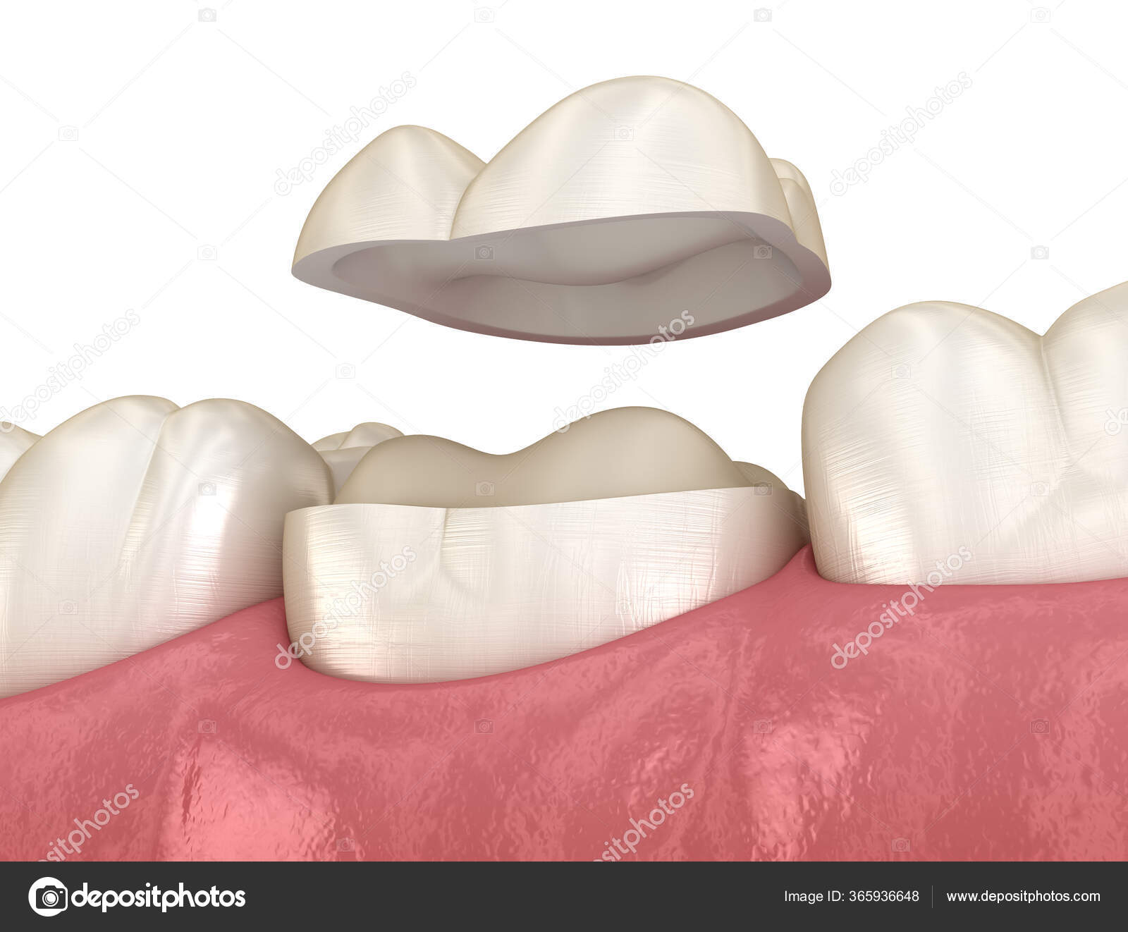 Onlay Ceramic Crown Fixation Molar Tooth Medically Accurate ...