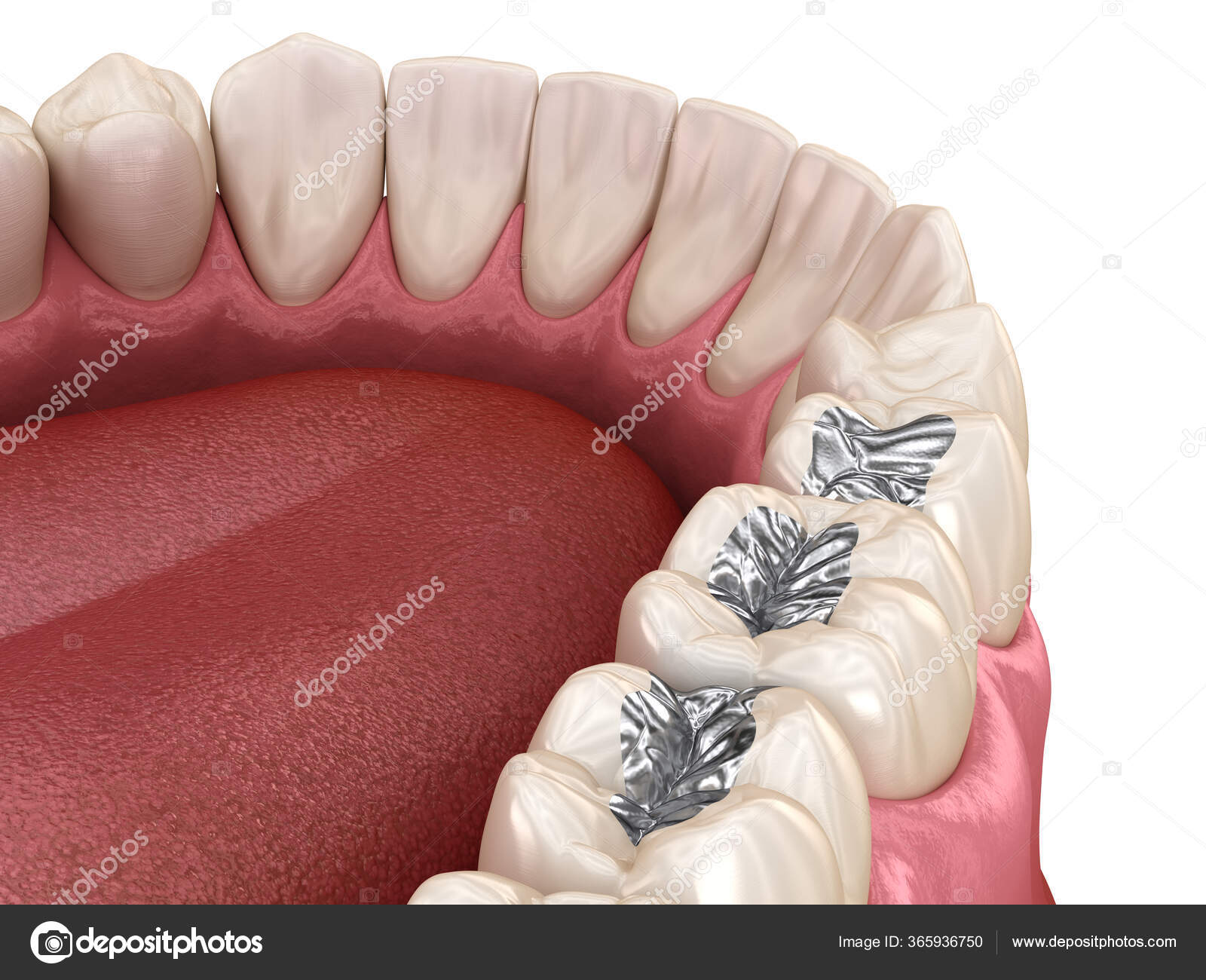 Restauración Amalgamas Animación Médicamente Precisa Del Concepto ...