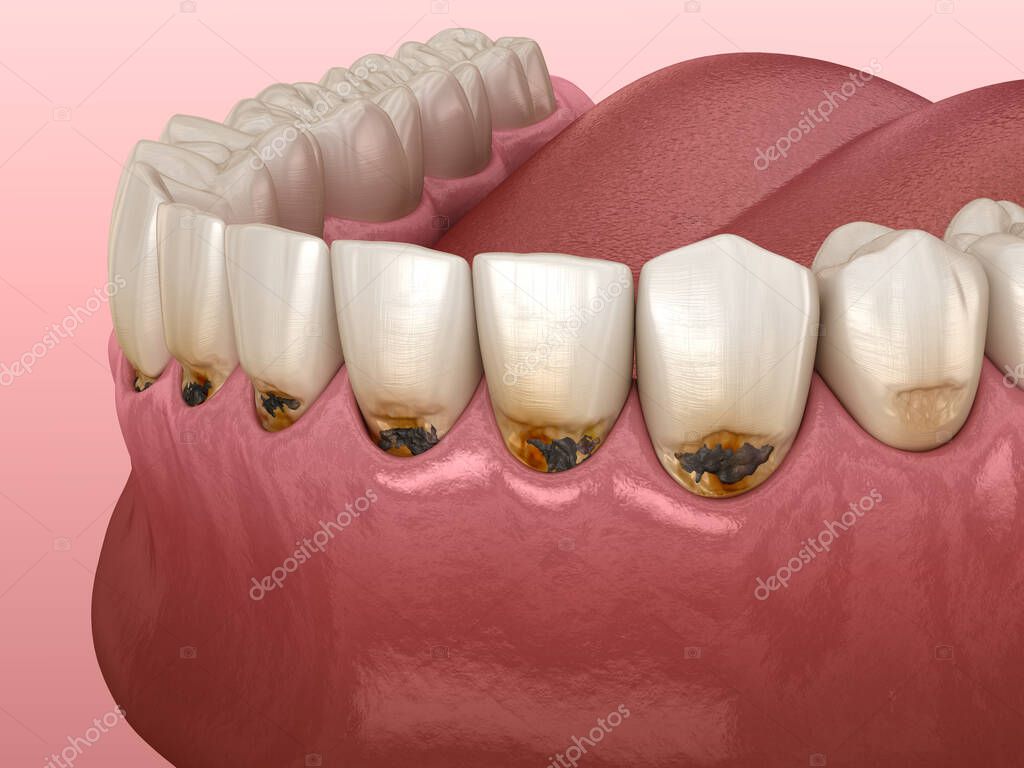 Caries cervical en dientes frontales. Ilustración 3D de dientes ...