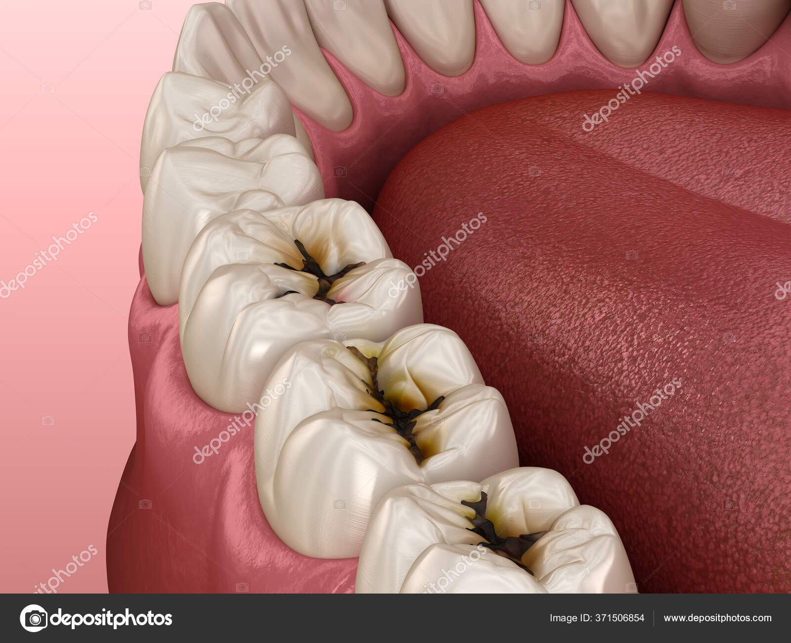 Durch Karies Geschädigte Backenzähne Medizinisch Korrekte Darstellung ...