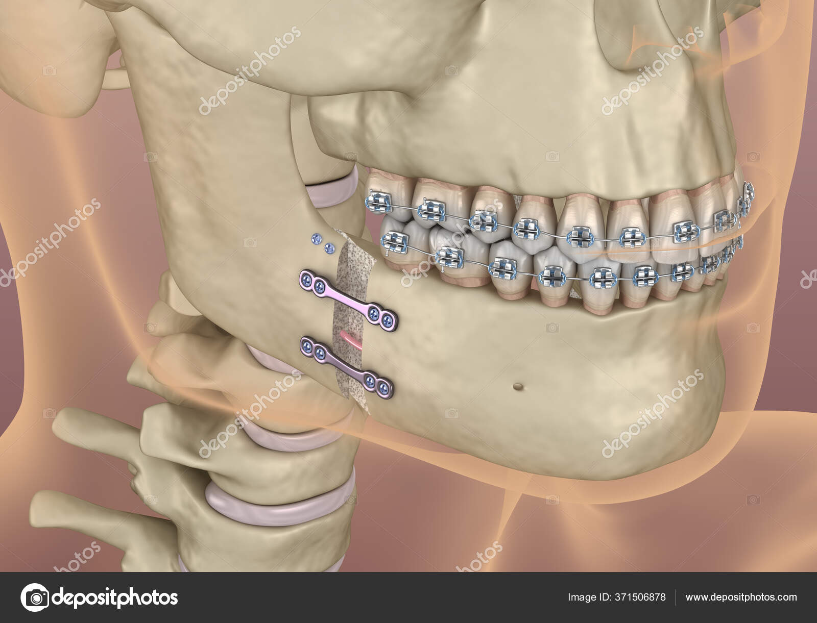 Mandibular Advancement Surgery Medically Accurate Dental Illustration ...