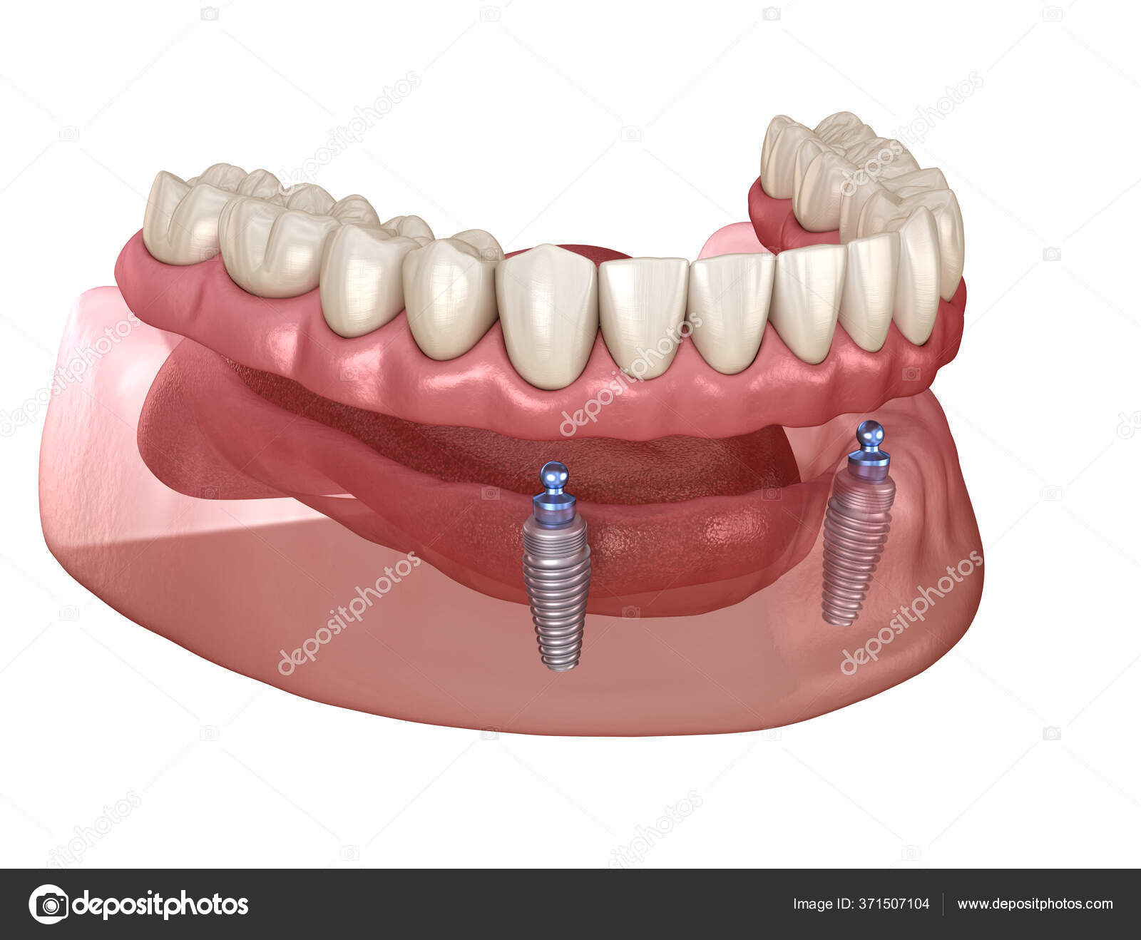 Mandibular Removable Prosthesis All System Supported Implants Ball ...