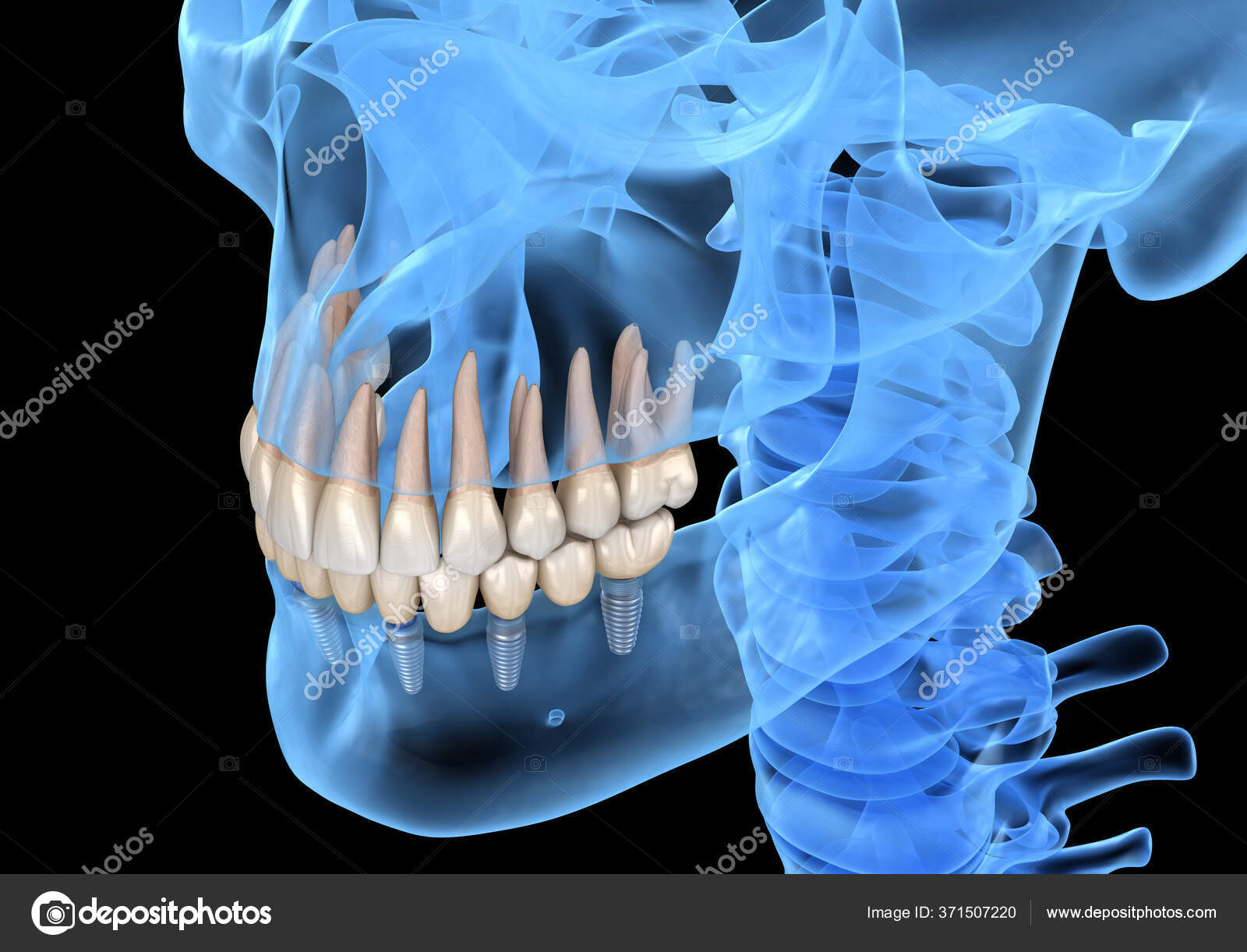Mandibular Prosthesis All System Supported Implants Medically Accurate ...