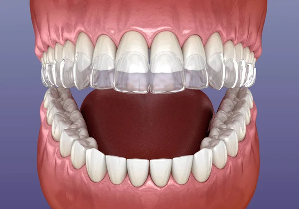 Incisives centrales Stock Photos, Royalty Free Incisives centrales ...