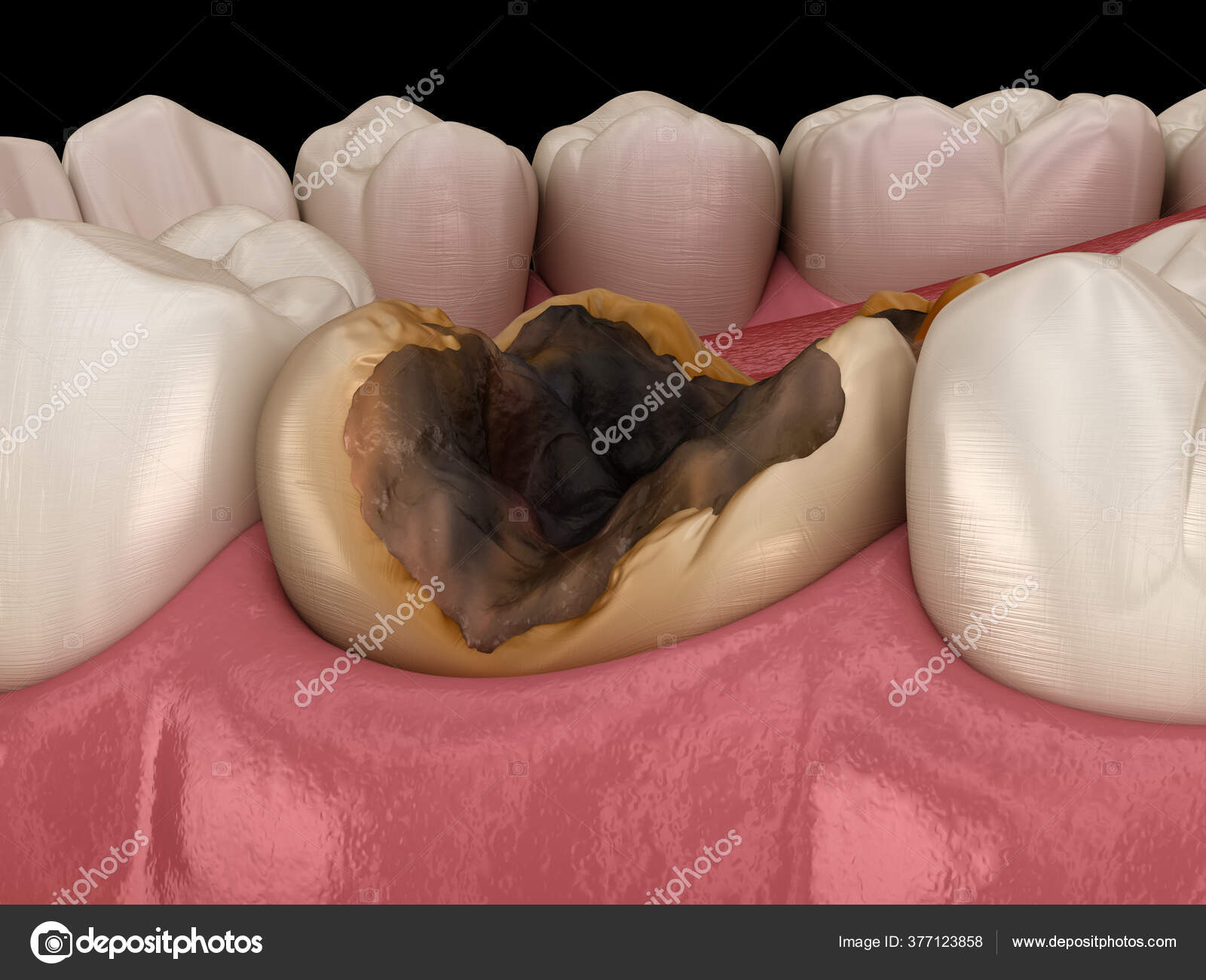 Molar Tooth Damaged Caries Medically Accurate Tooth Illustration Stock ...