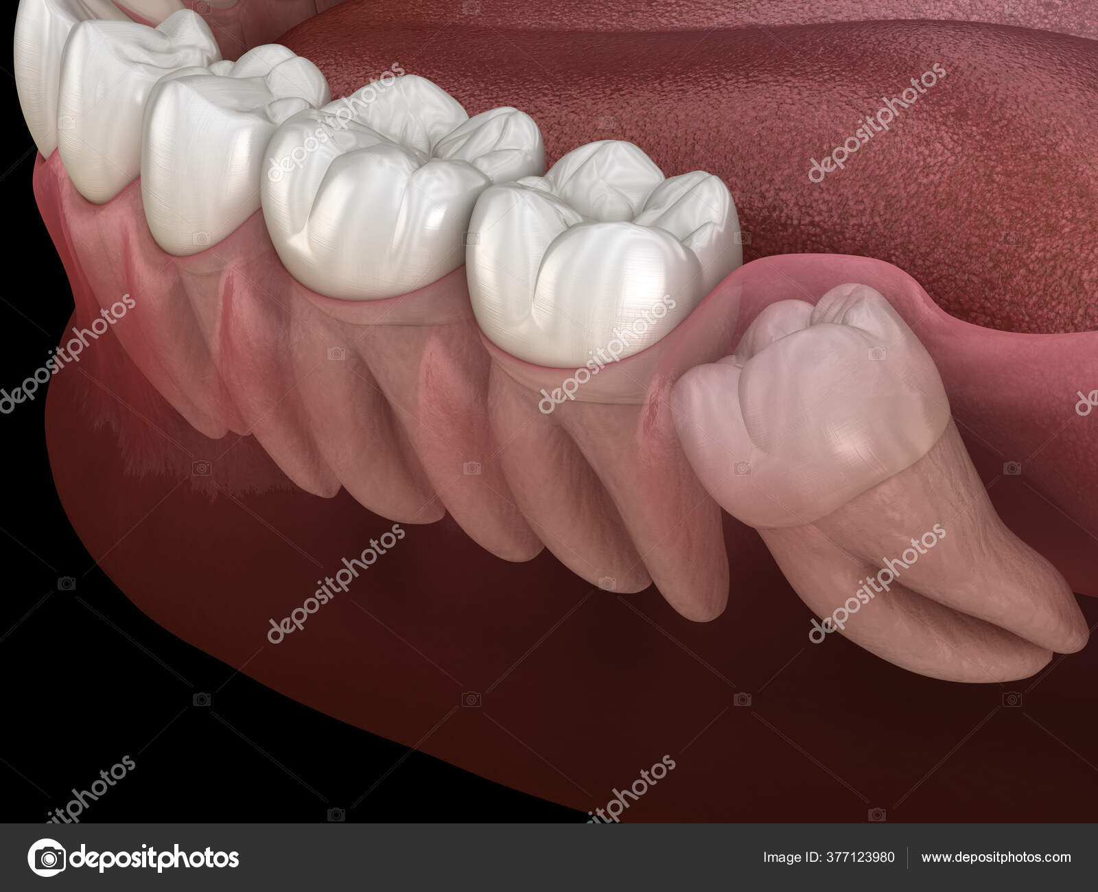 Wisdom Tooth Impaction Molar Tooth Medically Accurate Tooth ...