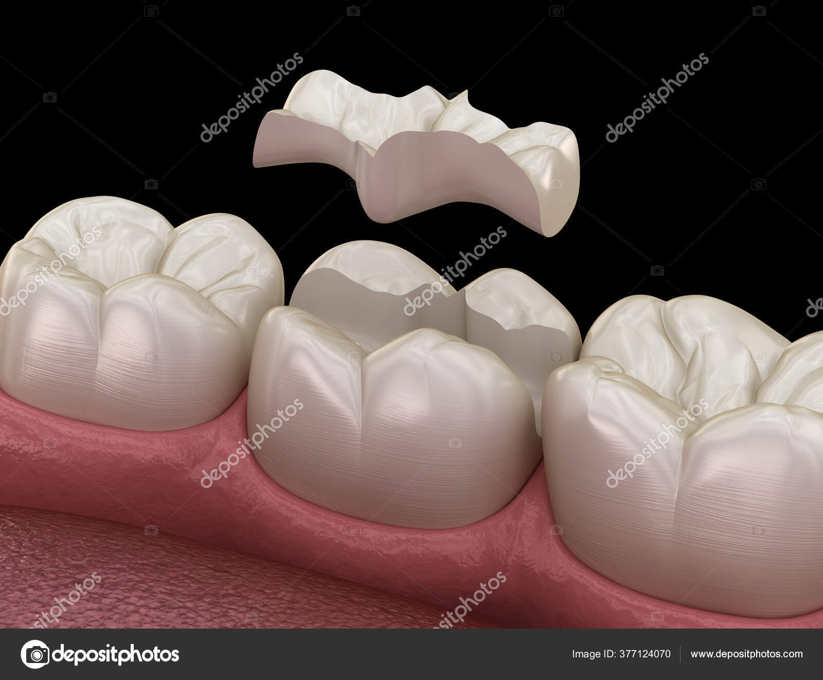 Inlay Ceramic Crown Fixation Tooth Medically Accurate Illustration ...