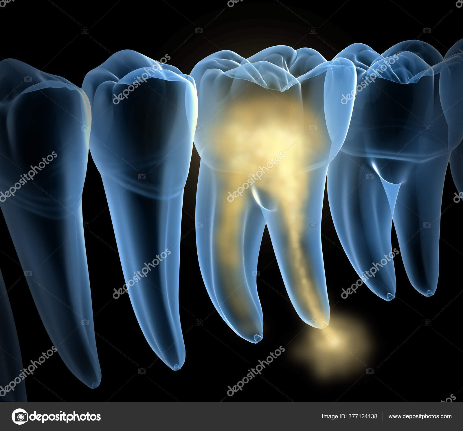 Damaged Molar Teeth Xray View Medically Accurate Tooth Illustration ...