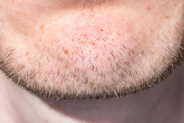 Rash on beard Stock Photos, Royalty Free Rash on beard Images ...