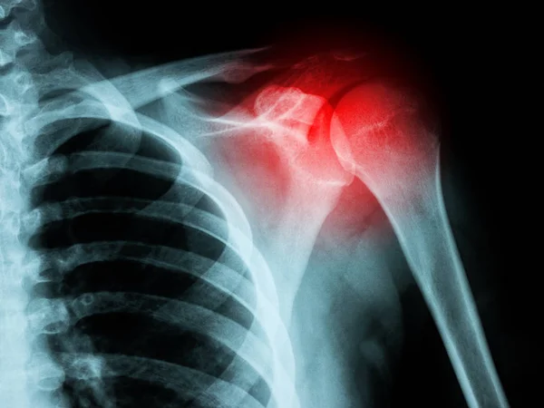 Shoulder fracture Stock Photos, Royalty Free Shoulder fracture Images ...