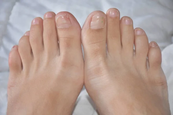 Webbed Toes Baby