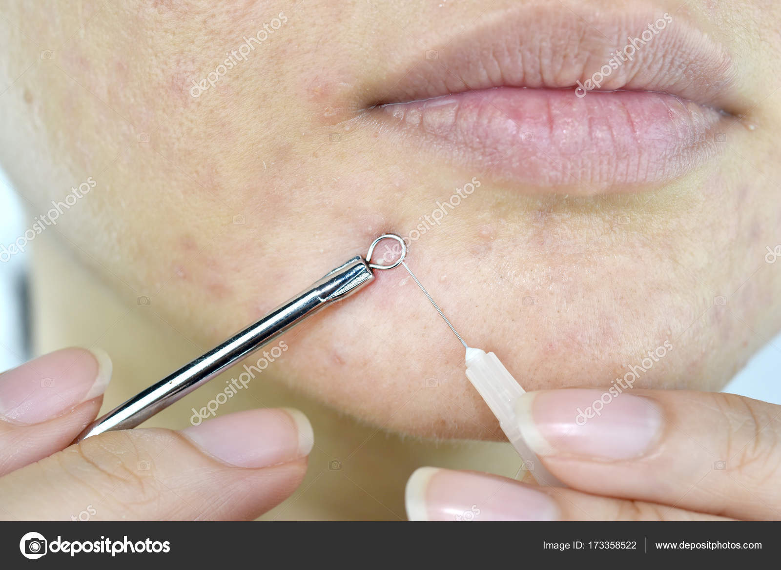 Whitehead Pimple On Lip