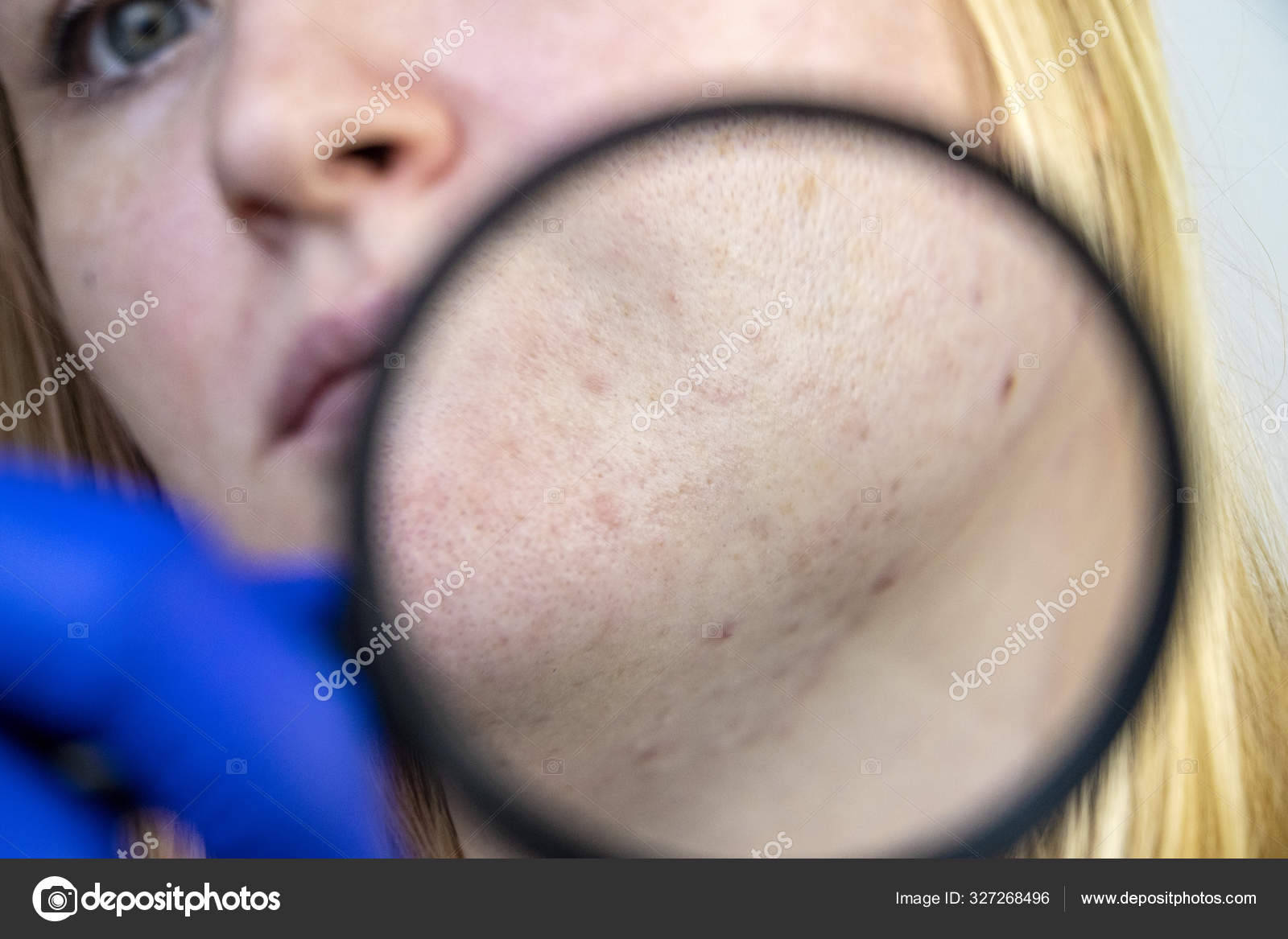 Post Acne Magnifying Glass Skin Acne Scars Woman Appointment ...