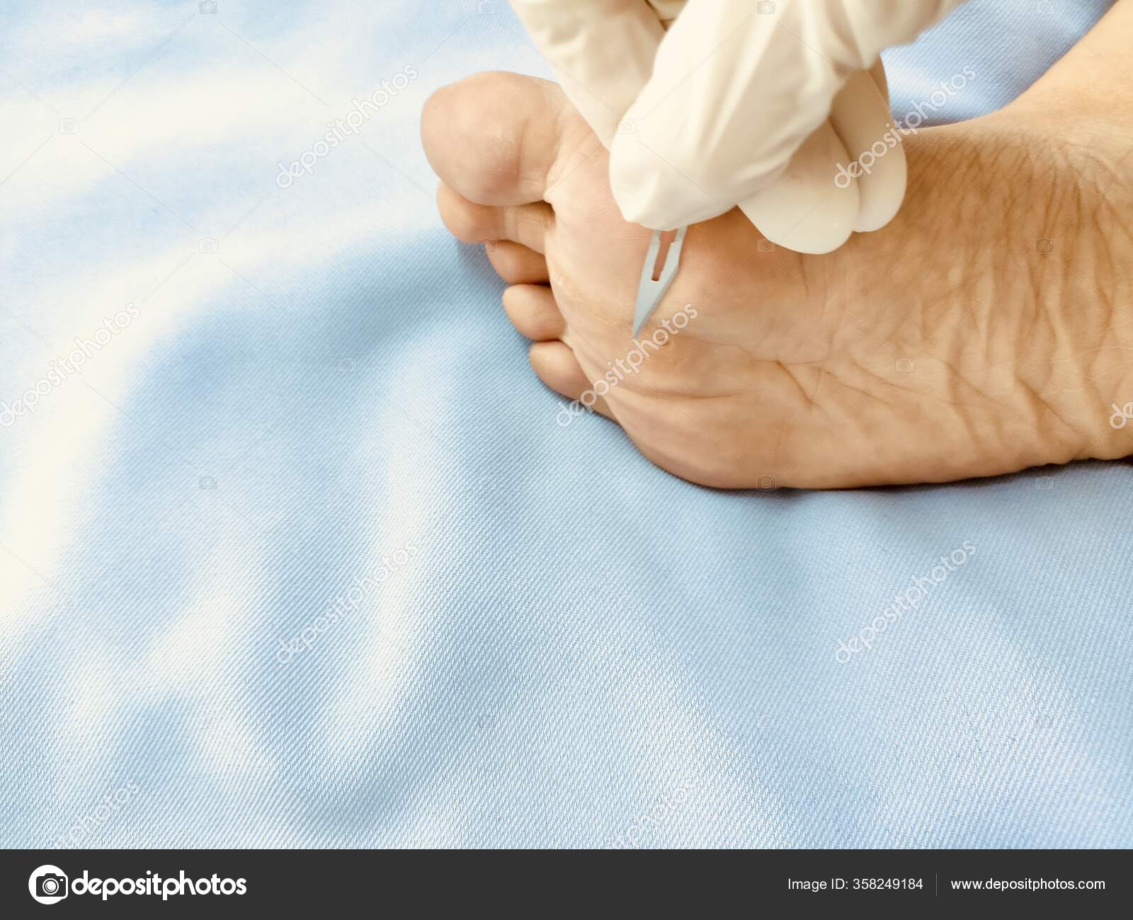 Бородавка На Ноге Фото – Telegraph