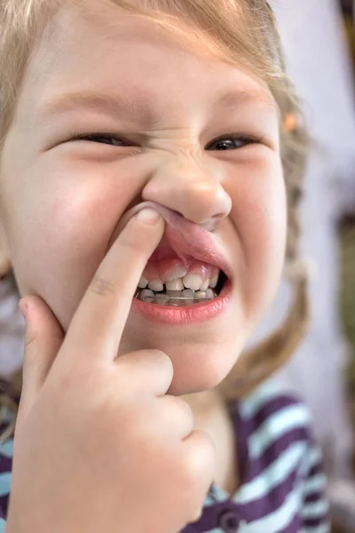 Adult permanent teeth coming in front of the child's baby teeth: ⬇ ...