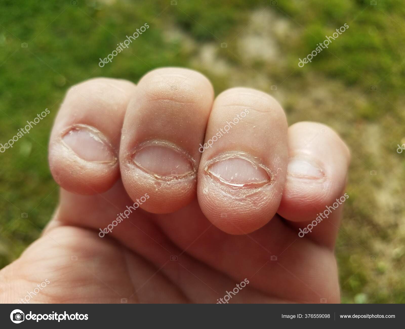 Bitten Nasty Unhealthy Gross Chewed Short Fingernails Bad Habit — Stock ...