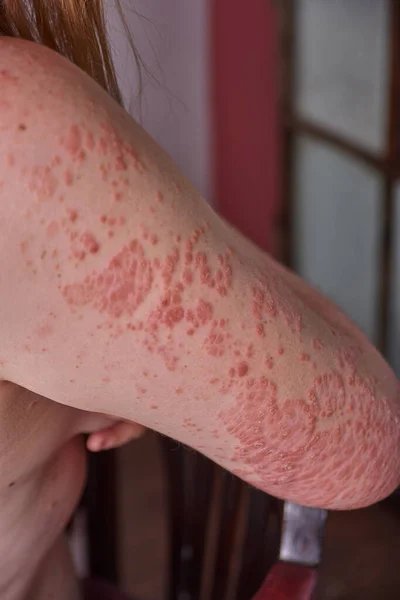 Mujer infectada images libres de droit, photos de Mujer infectada ...