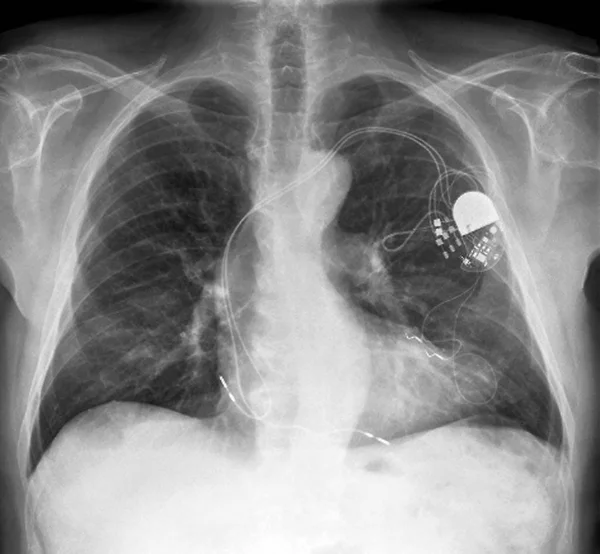 Pacemaker xray Stock Photos, Royalty Free Pacemaker xray Images ...