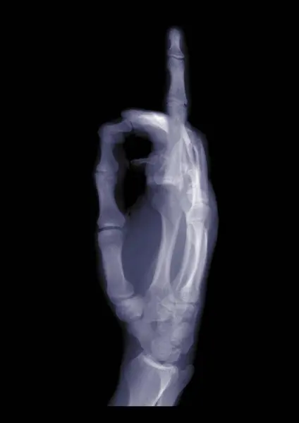 X ray fracture of the finger Stock Photos, Royalty Free X ray fracture ...
