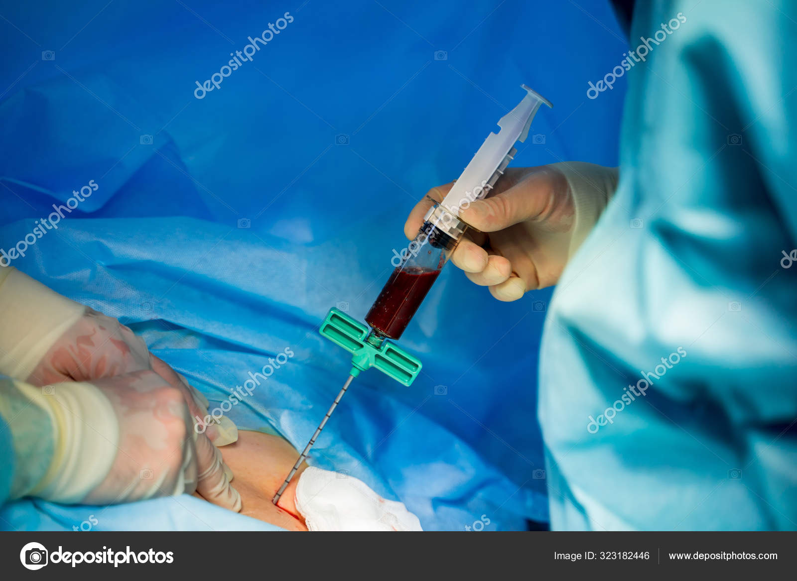Plasma in syringe. Specialist makes injection with syringe. Prof ...