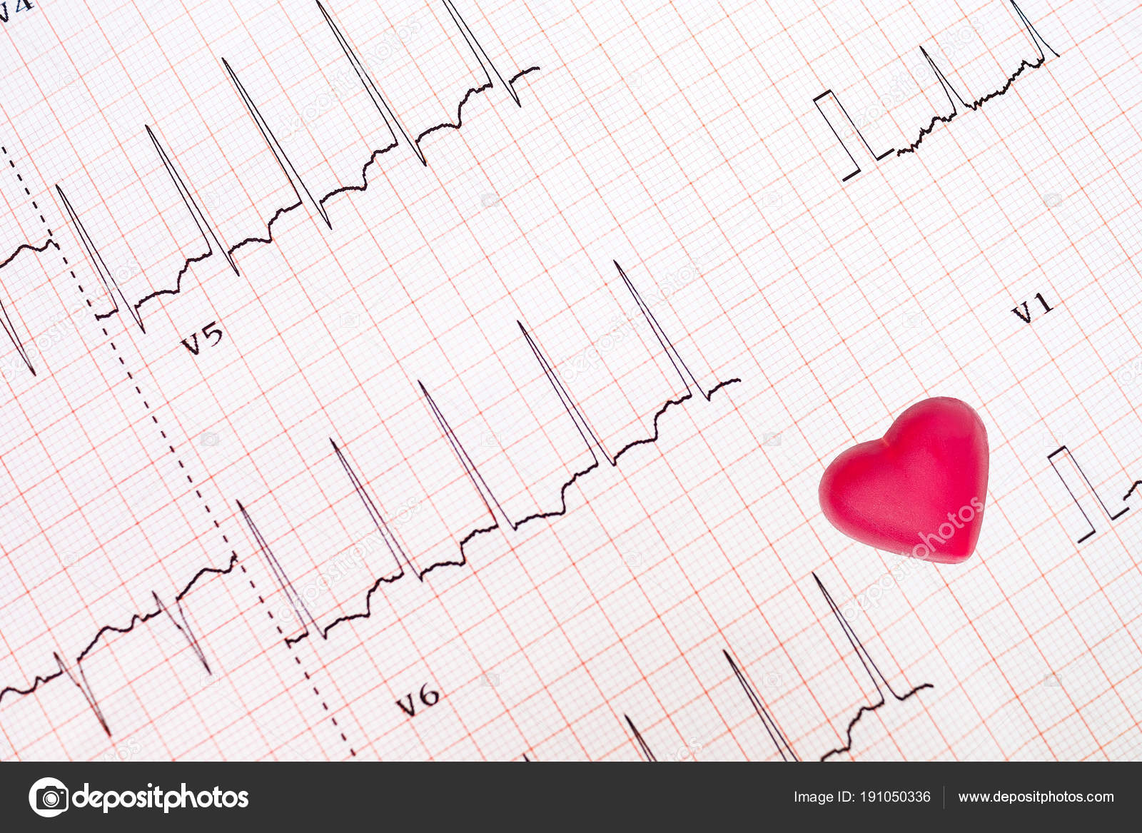 Abnormal Electrocardiogram