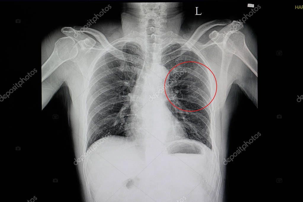 una radiografía de tórax de un paciente lesionado por una pared ...