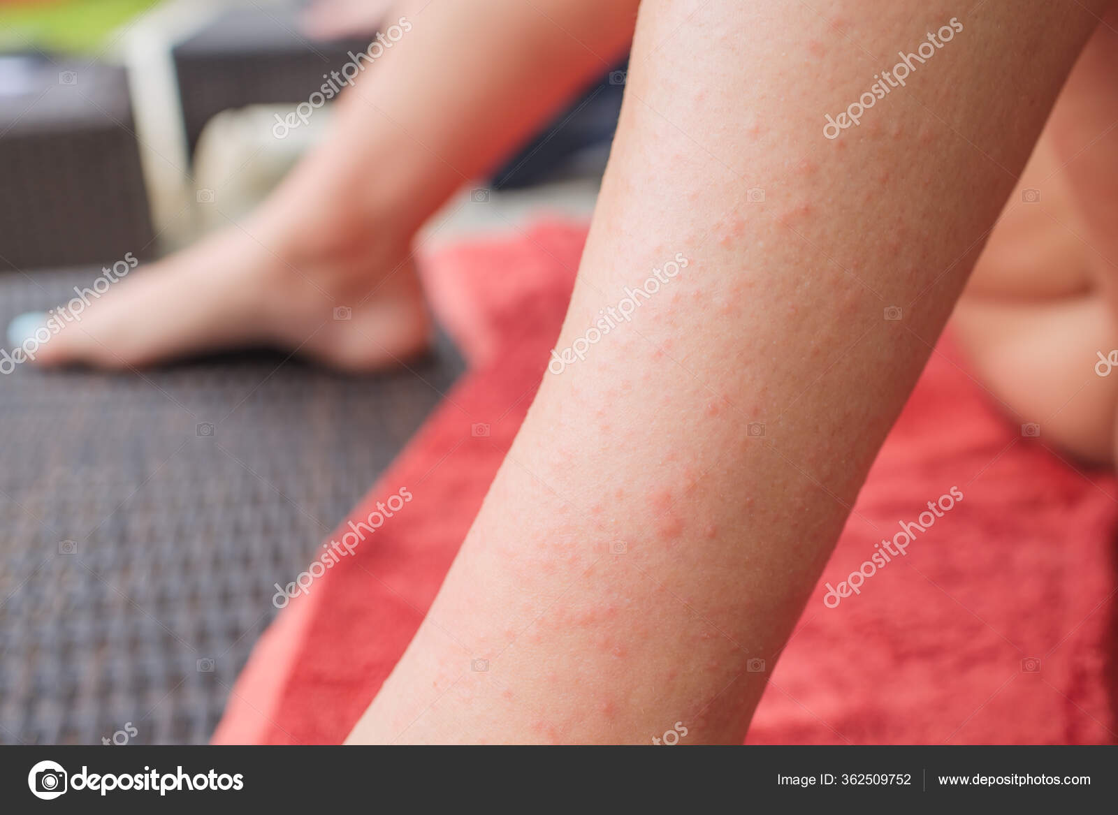 Dermatitis Herpetiformis skin rash in a woman with Nonceliac Gluten ...