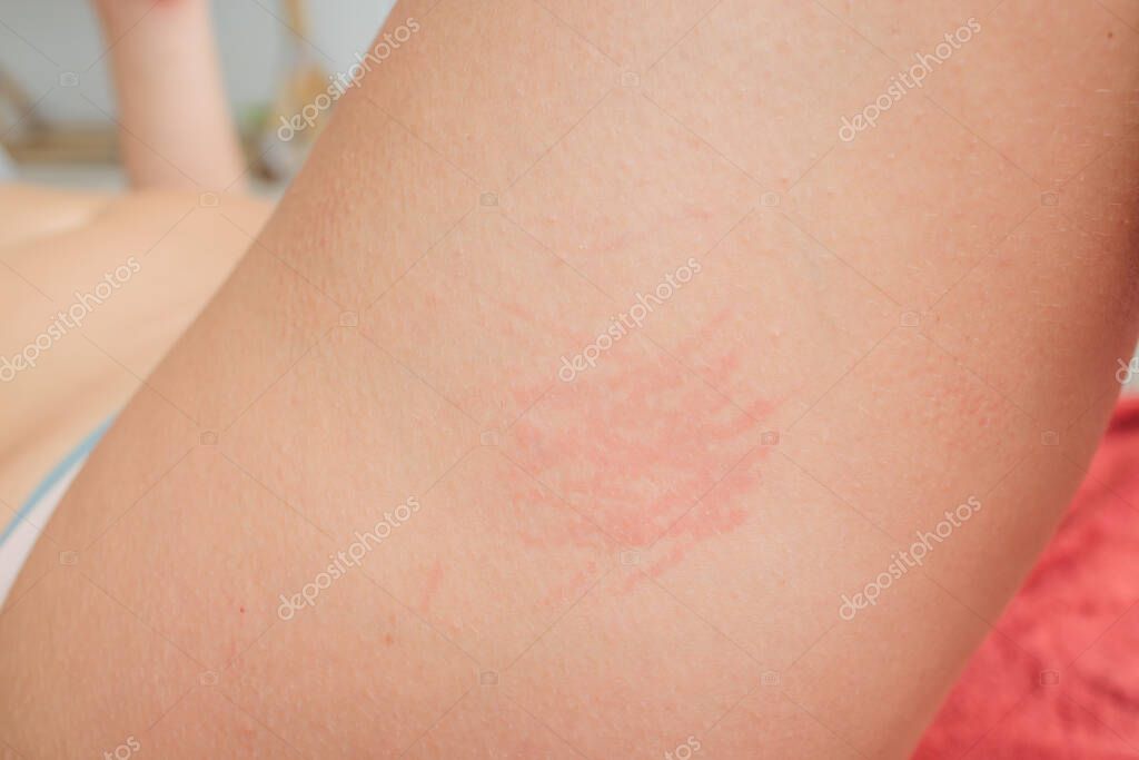 Dermatitis Herpetiforme erupción cutánea en una mujer con sensibilidad ...