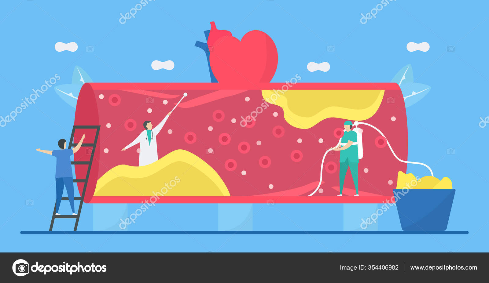 Cardiology Vector Illustration Atherosclerosis Heart Disease Plaque ...