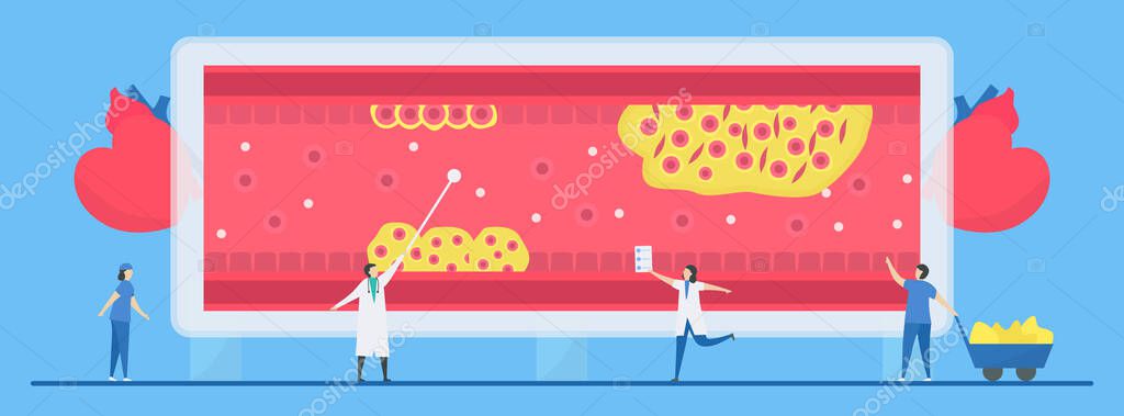 Ilustración Del Vector Cardiológico La Aterosclerosis Es Una