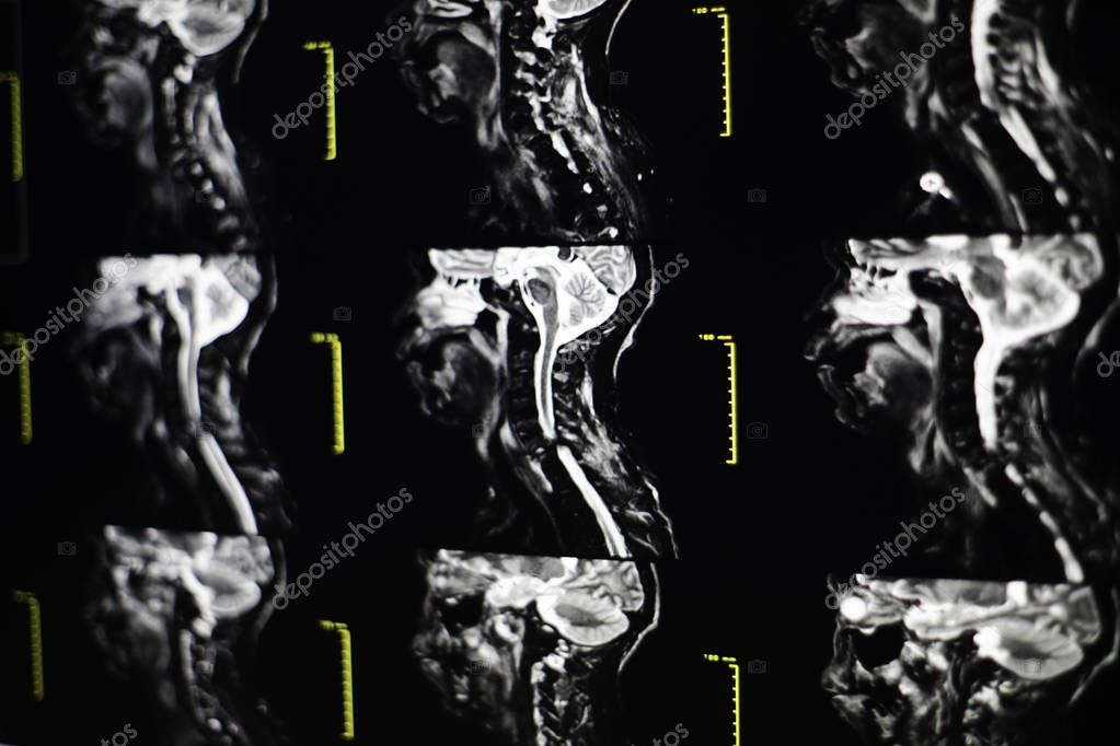 Resonancia magnética C-columna vertebral, cuello, imagen 6view mostrar ...