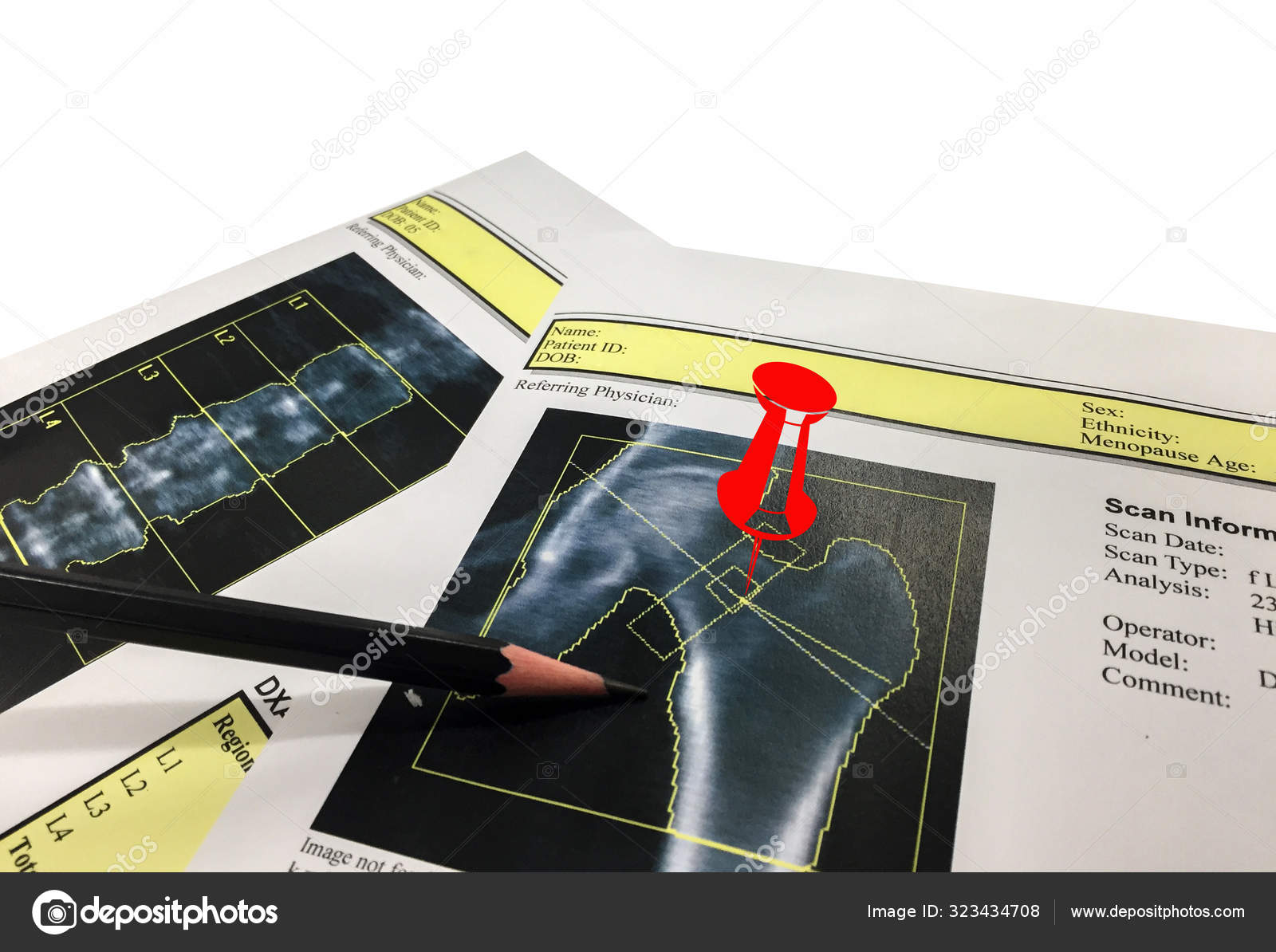 Hip and Spine Bone mineral density (BMD) — Stock Photo © Richmanphoto ...