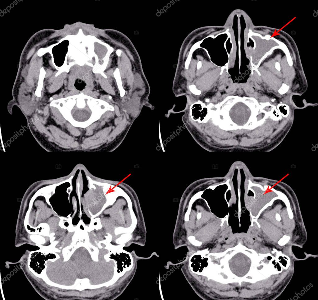 CT Cerebro y senos paranasales Impresión: Sinusitis crónica de 2022