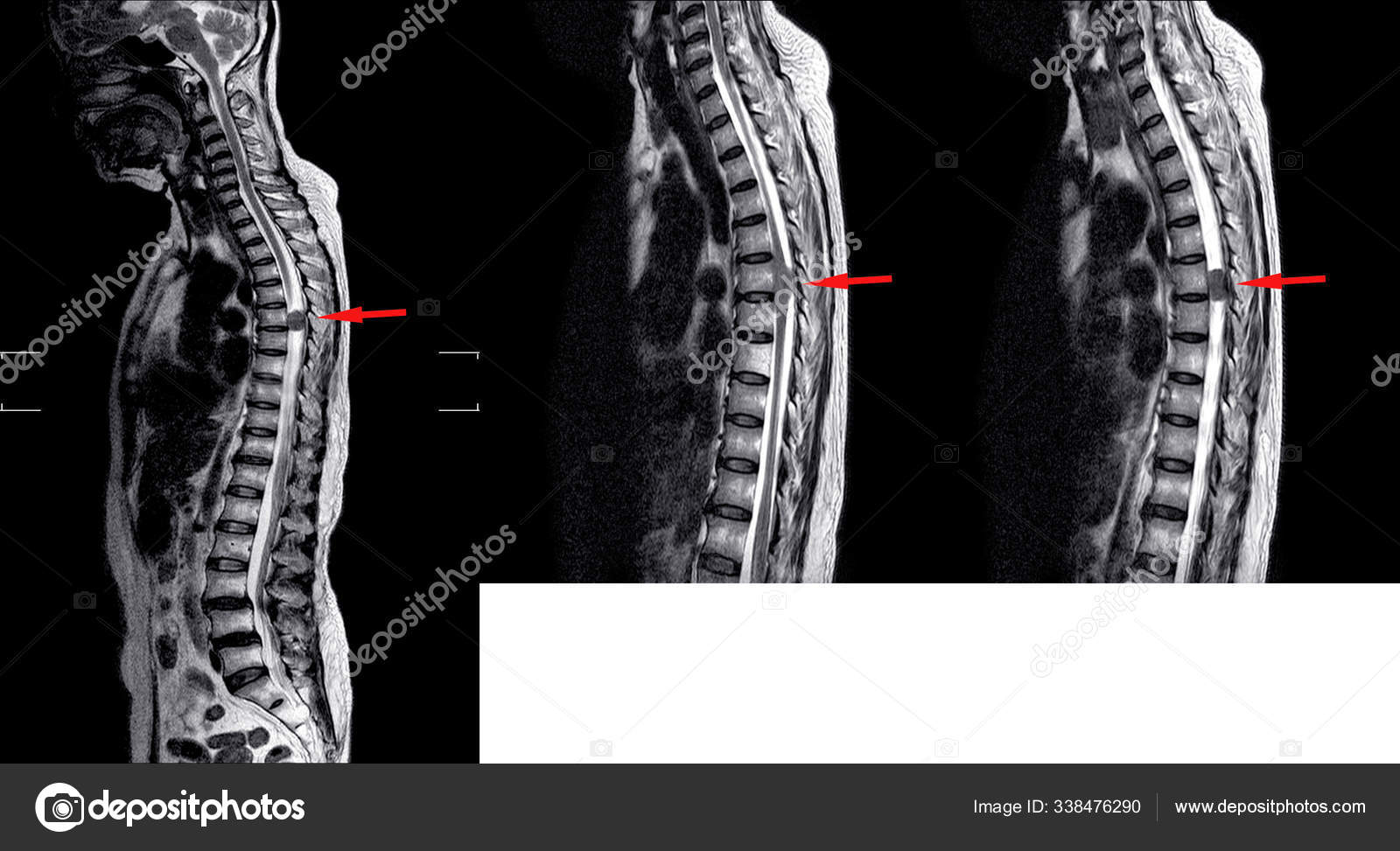 Normal Thoracic Spine Mri