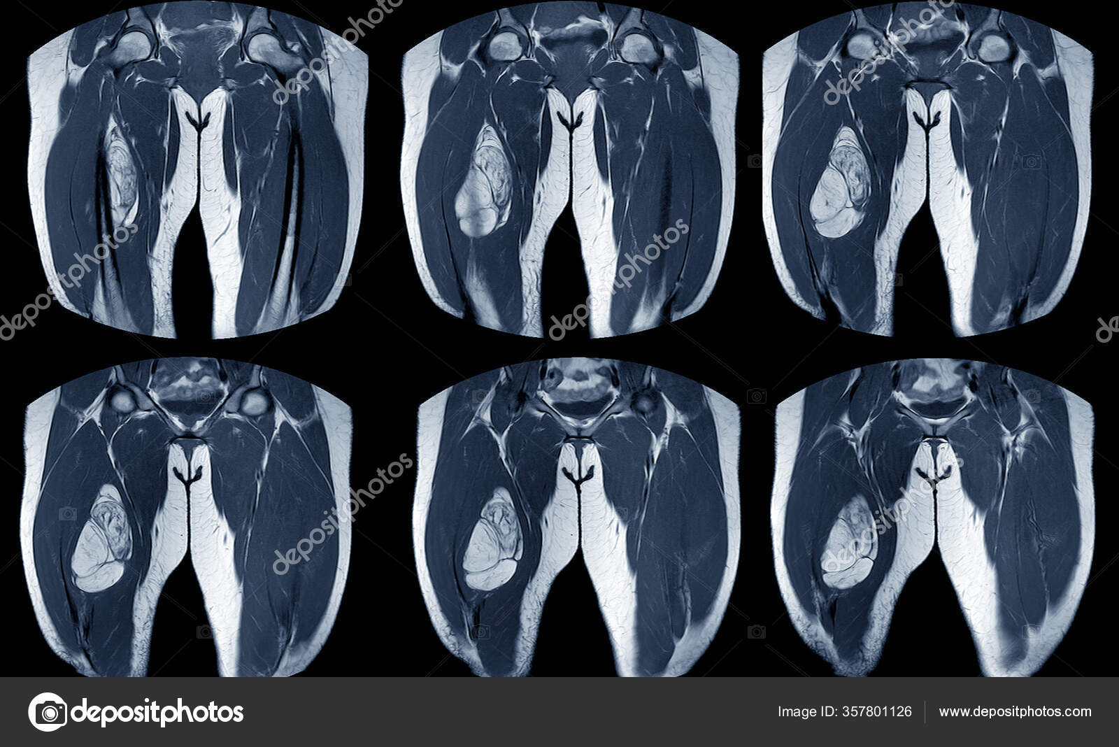Resonancia Magnética De La Anatomía Del Muslo Tratamiento Eficaz