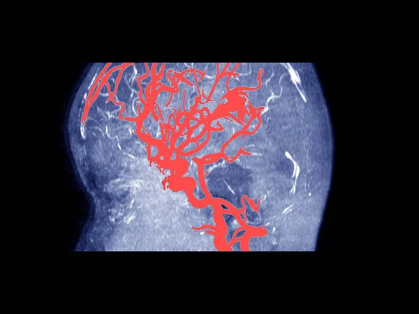 RMN DEL CEREBRO Y RMN Y RMN DEL CEREBRO Edema vasogénico perilesional ...