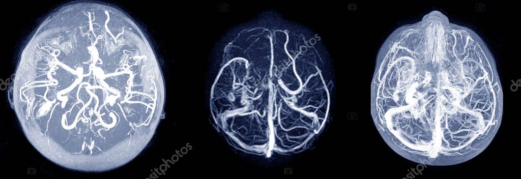 RMN DEL CEREBRO Y RMN Y RMN DEL CEREBRO Edema vasogénico perilesional ...