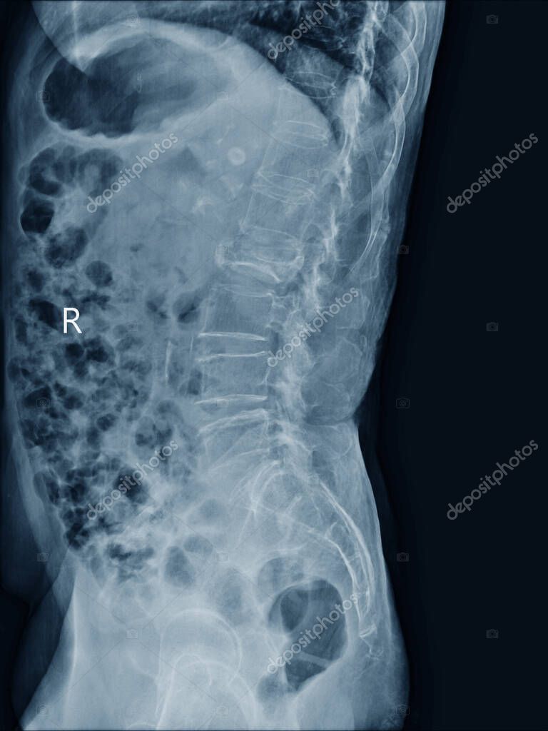 Resonancia magnética de columna lumbar El estudio revela fractura por ...